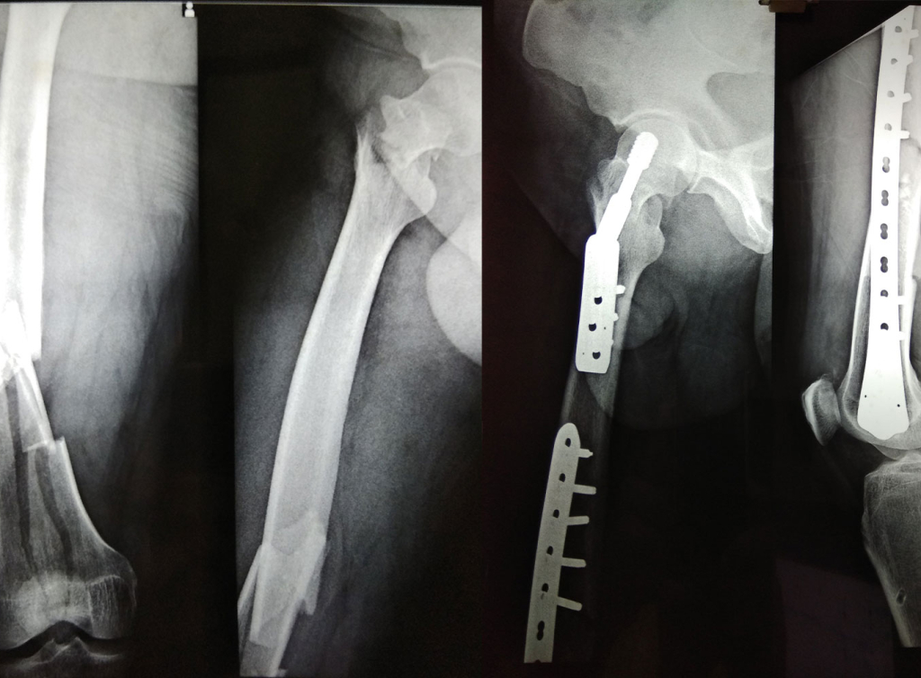All Fracture Fixations – totalkneesolutions.com