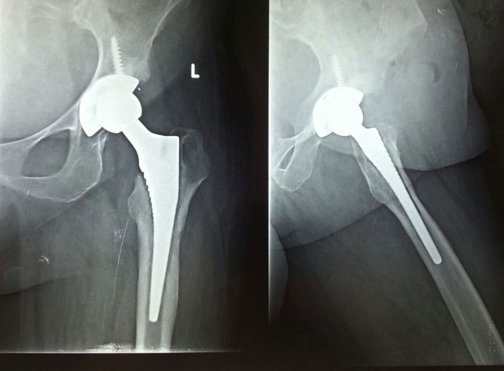 Hip Replacement – totalkneesolutions.com